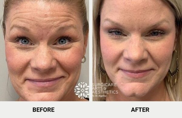 Botox Results Timeline: How Long Until You See Results?