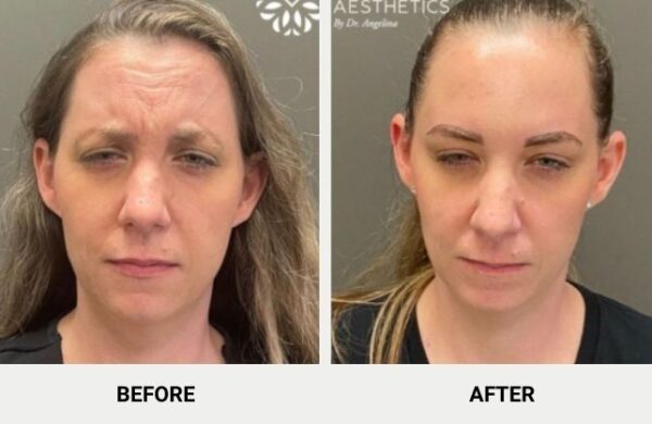 Botox Results Timeline: How Long Until You See Results?