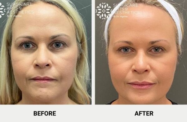 Botox Results Timeline: How Long Until You See Results?