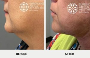 These FaceTite™ Results Make You Believe In Magic