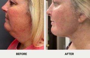 These FaceTite™ Results Make You Believe In Magic