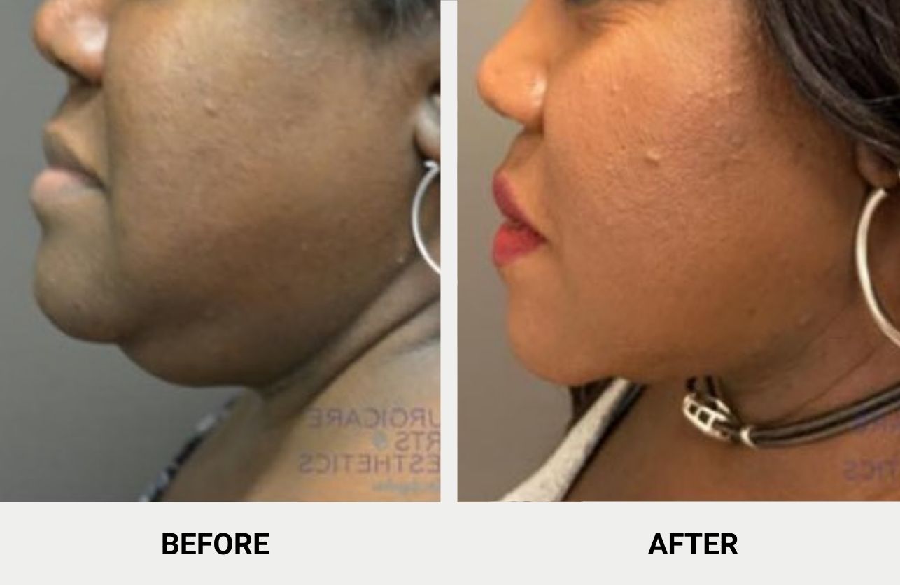 These FaceTite™ Results Make You Believe In Magic