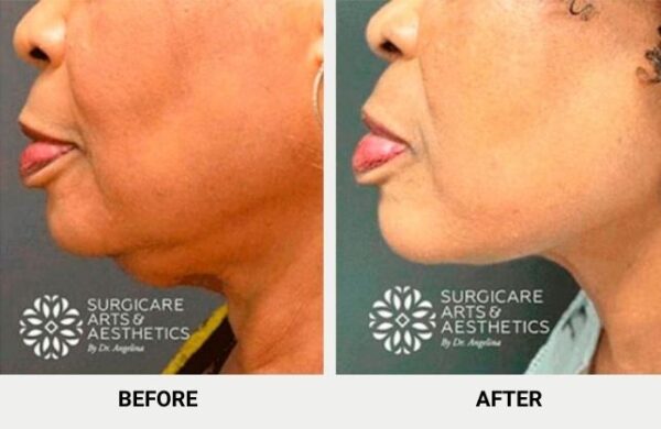 These FaceTite™ Results Make You Believe In Magic