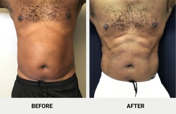 Body Sculpting For Men: The Fastest Growing Procedures