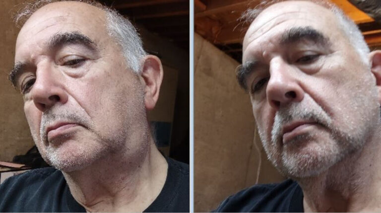 Lipoma vs. Cyst: Key Differences and How to Treat Them